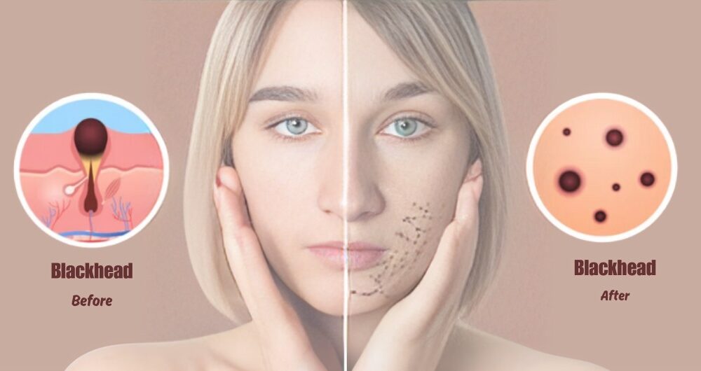 Blackhead removal: causes, symptoms and treatment